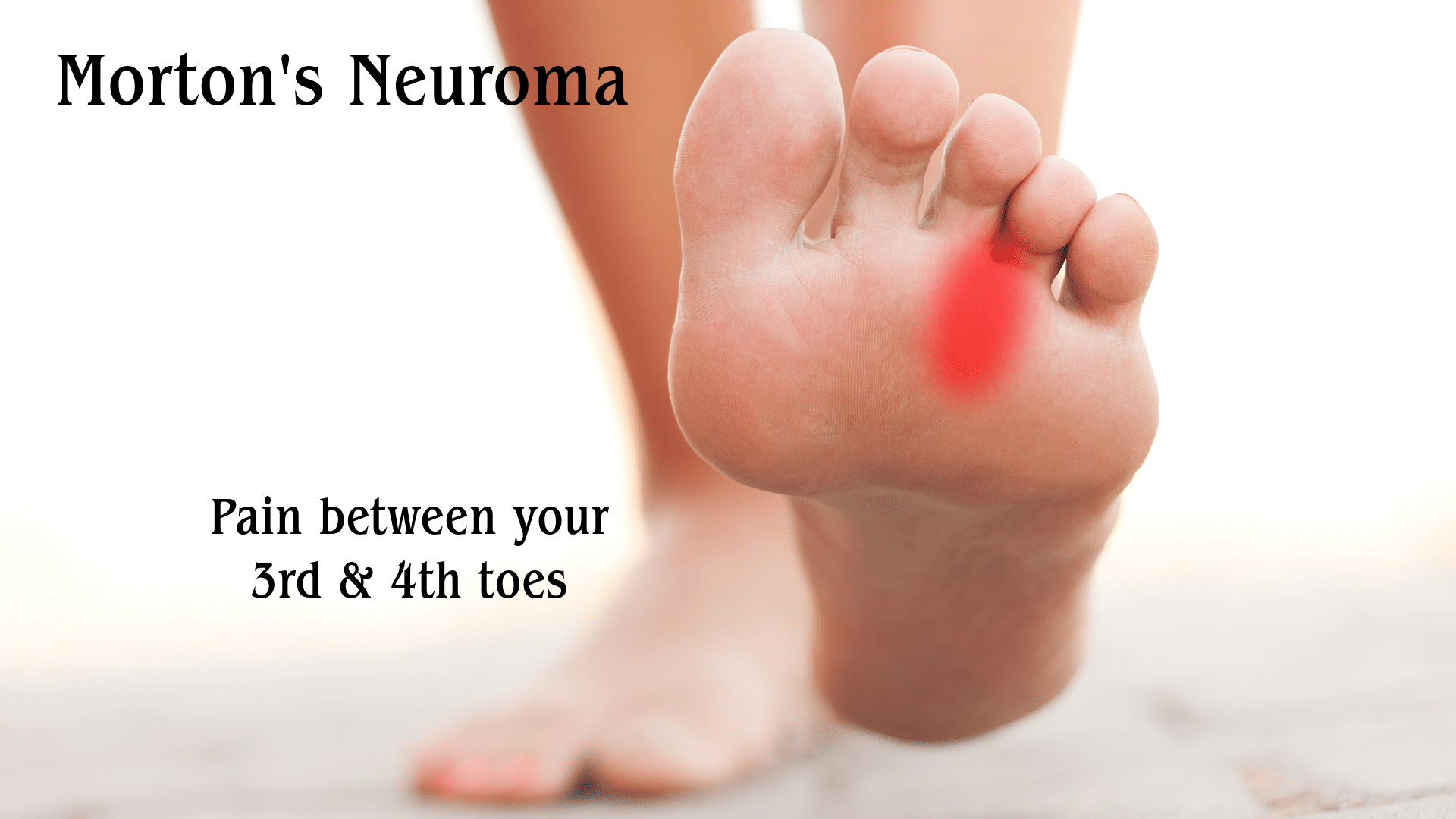 Intermetatarsal Neuroma - Morton's Neuroma Treatment